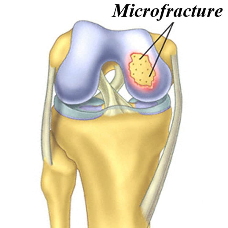 Cartilagem | Dr. Fernando Cury Rezende