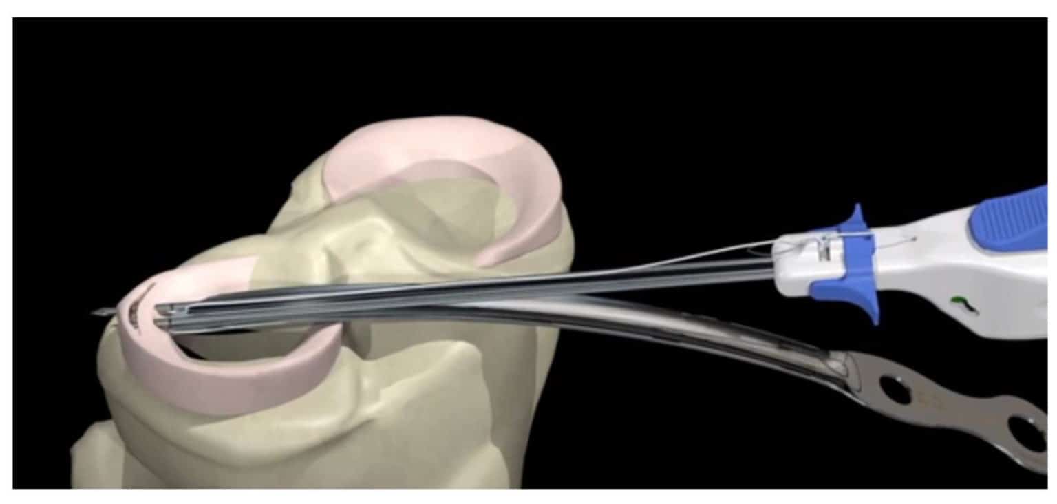 Ruptura dos Meniscos - Dr. Fernando Cury Rezende
