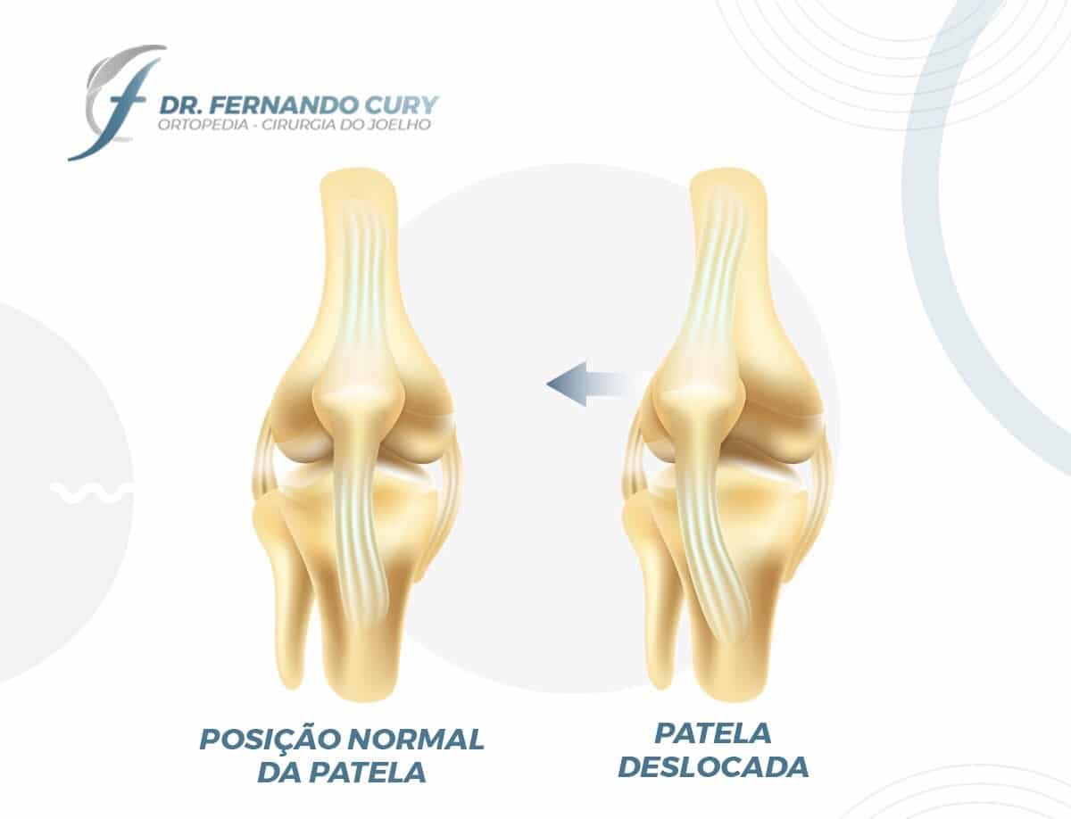 Luxação da patela precisa de tratamento cirúrgico? - Dr. Fernando Cury