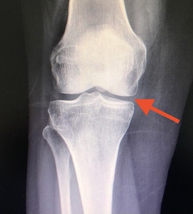 Tratamento e cirurgia do menisco. Leitura importante! - Dr. Fernando Cury